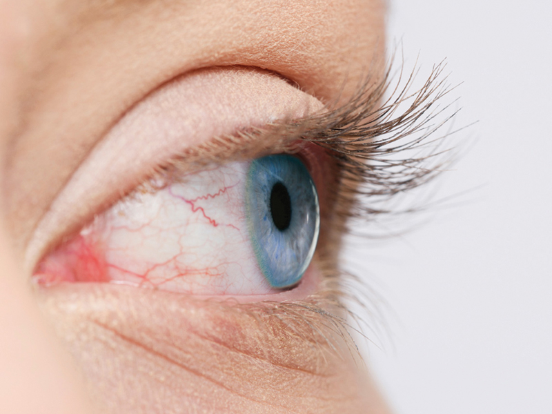 Dry Eye Treatment Plans | Midwest Eye Consultants