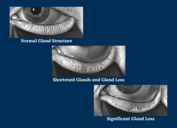 IRPL: Finally, a Long-Lasting Treatment for Dry Eye - Midwest Eye ...